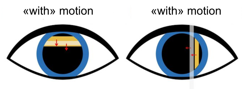 Retinoscopy - Ophtha.info
